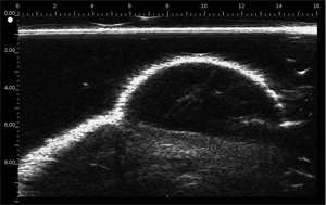 MEDLAB IATΡΙΚΟ ΙΝΣΤΙΤΟΥΤΟ ΠΕΡΗΧΟΣ ΔΕΡΜΑΤΟΣ - Sub-epidermal bubble ...
