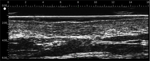 MEDLAB IATΡΙΚΟ ΙΝΣΤΙΤΟΥΤΟ YΠΕΡΗΧΟΣ ΔΕΡΜΑΤΟΣ - Hypertrophic scar ...