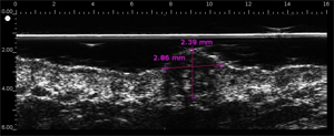MEDLAB ΙΑΤΡΙΚΟ ΙΝΣΤΙΤΟΥΤΟ YΠΕΡΗΧΟΣ ΔΕΡΜΑΤΟΣ - Compound nevus- ΚΑΡΚΙΝΟΣ ...
